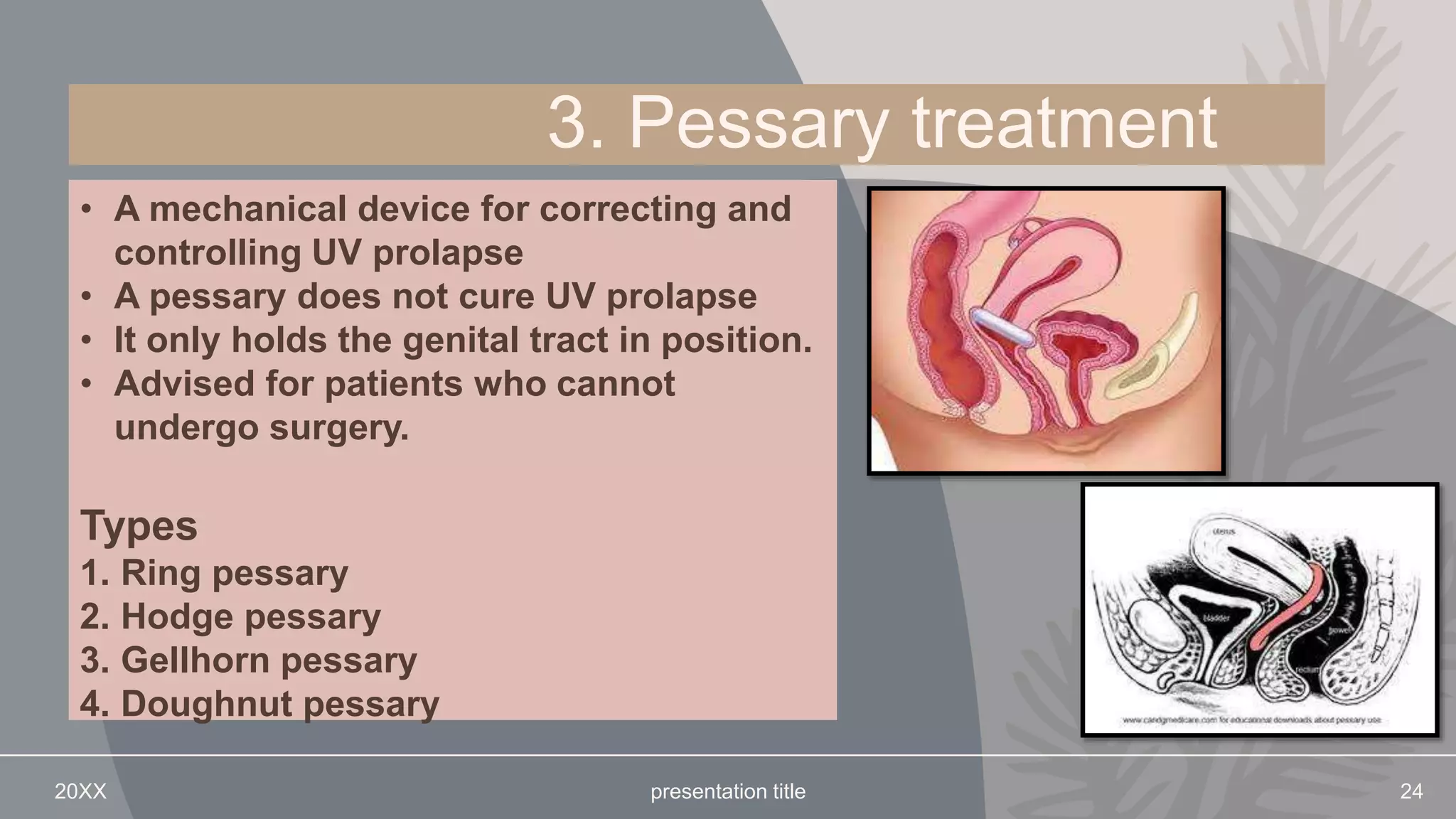 Prolapse of the uterus.pptx