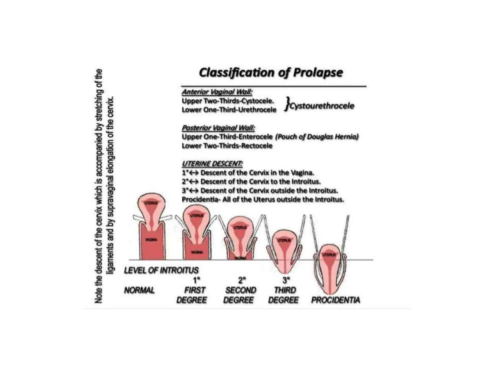 Prolapse of Uterus.pptx
