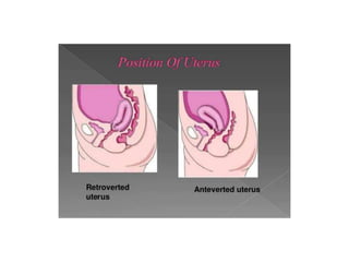 Prolapse of Uterus.pptx