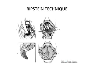 Prolapse rectum | PPT