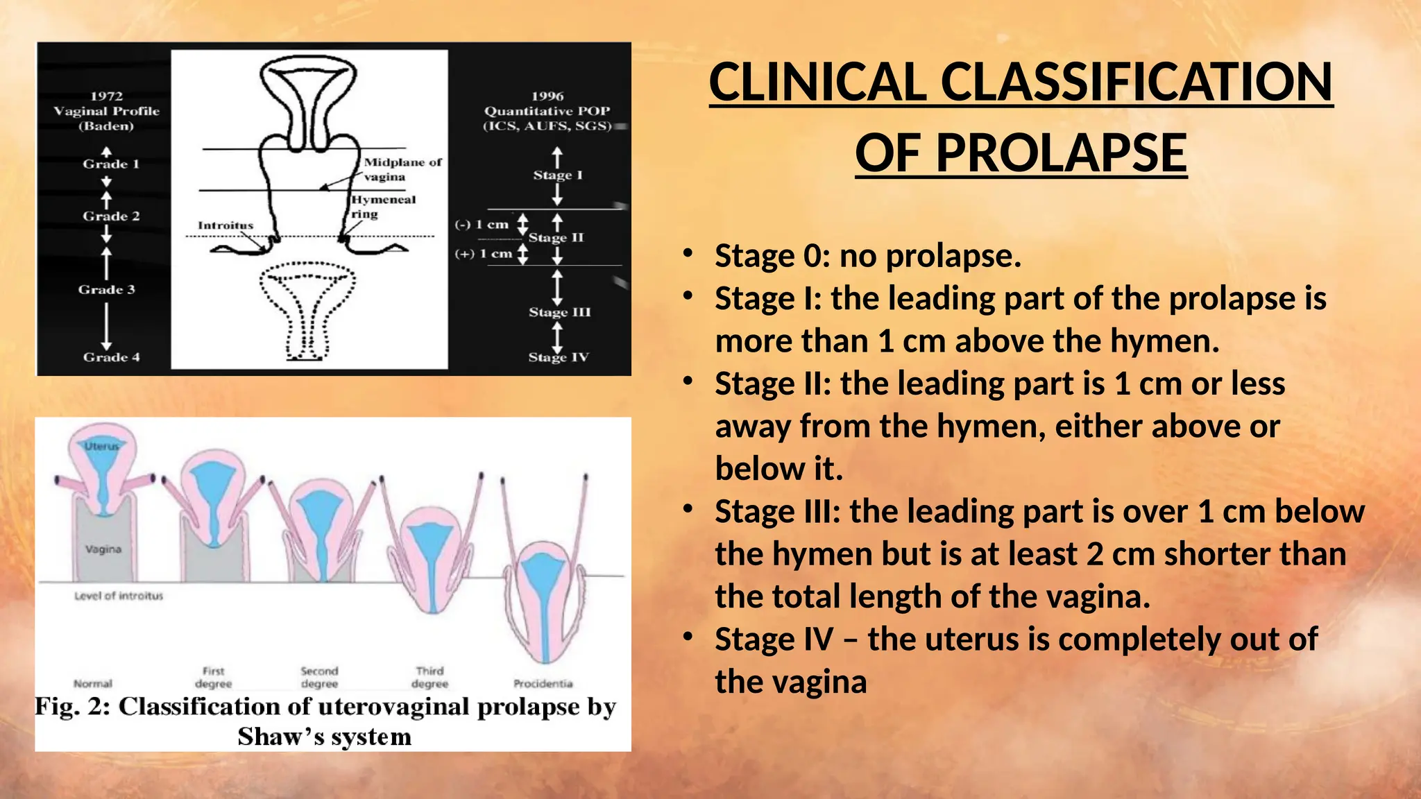 Prolapse Types gynecology practice in medicine | PPTX