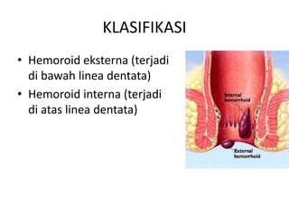Prolaps hemoroid | PPTX