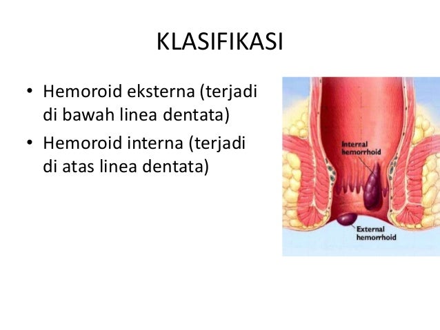 Prolaps hemoroid
