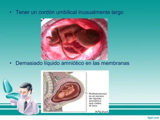 Prolapso de cordon umbilical | PPT