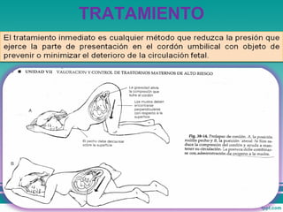 Prolapso de cordon umbilical | PPT