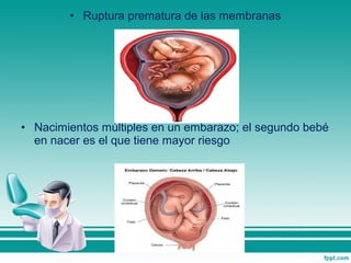 Prolapso de cordon umbilical | PPT