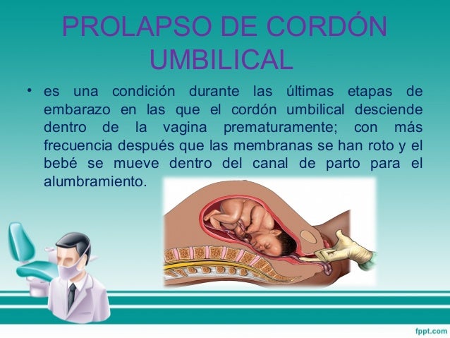 Prolapso de cordon umbilical