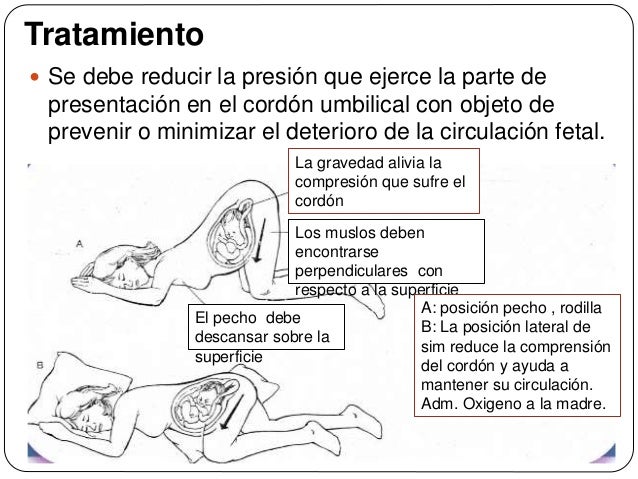 Prolapso de cordon umbilical