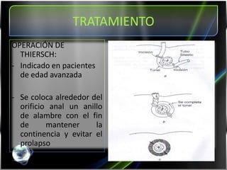 Prolapso rectal | PPTX