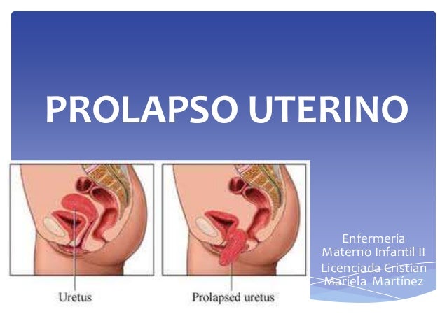 Prolapso uterino