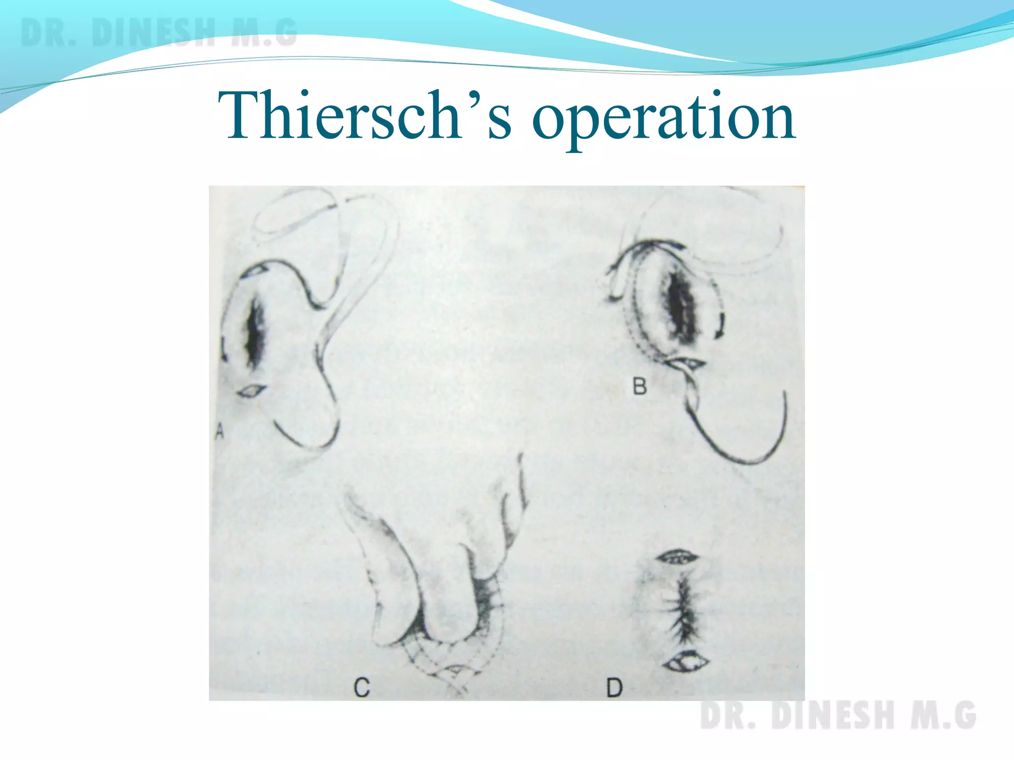 Prolapsse of Rectum | PPT