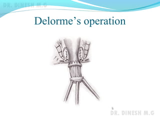 Prolapsse of Rectum | PPT