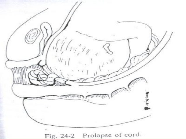 PROLAPS TALI PUSAT - PLASENTA TERSEKAT