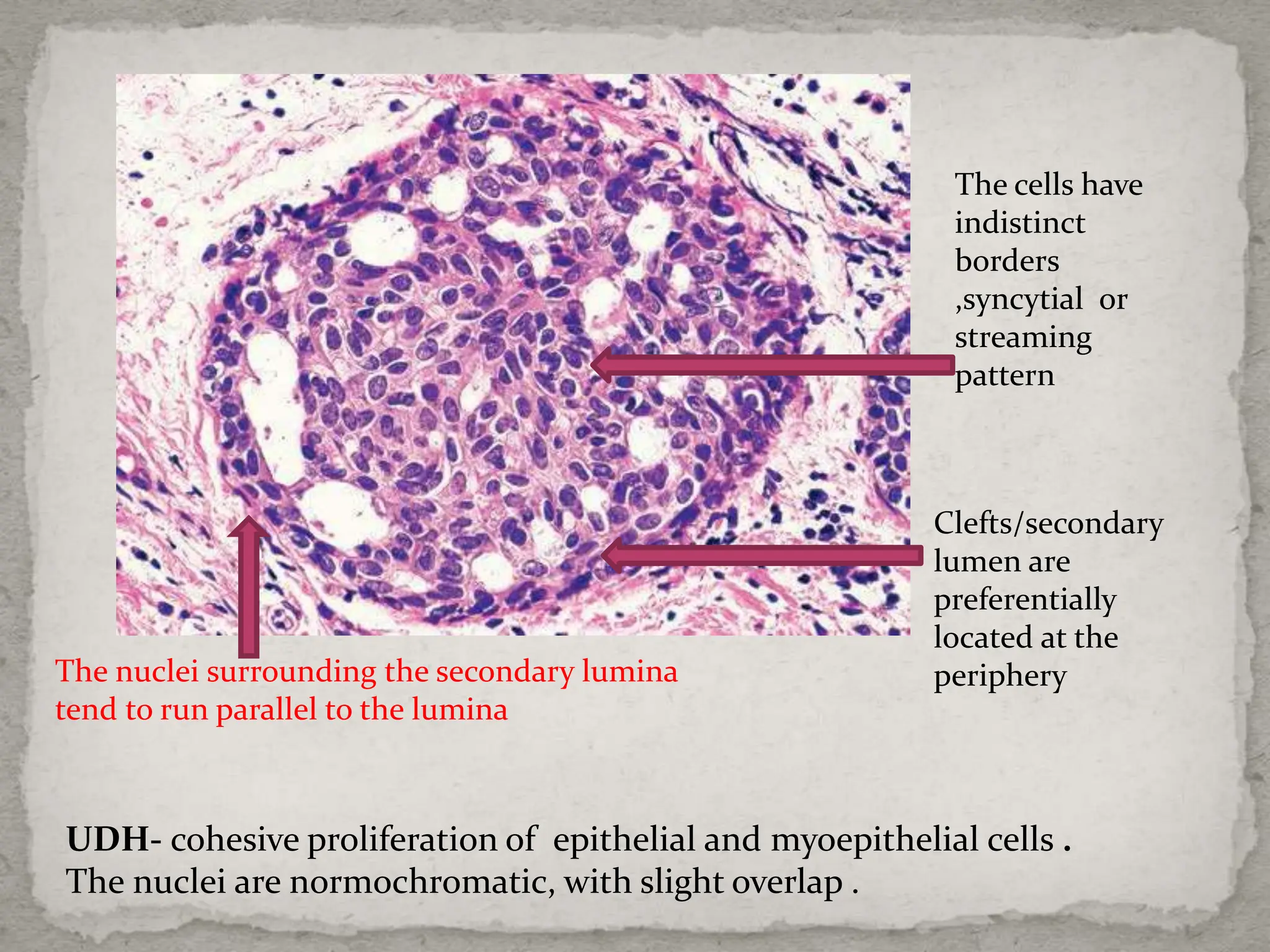 An approach to proliferative disease of breast .pptx