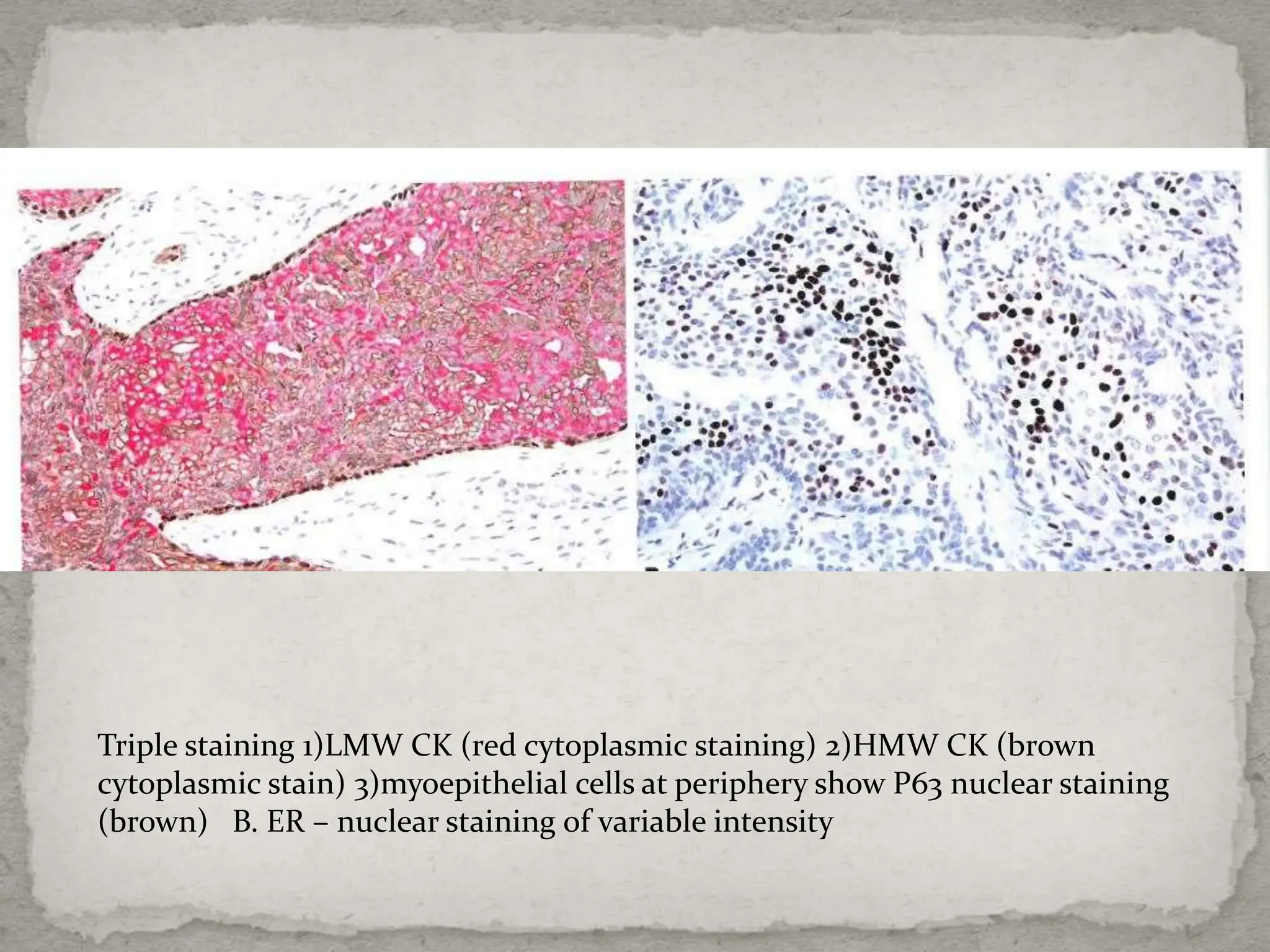 An approach to proliferative disease of breast .pptx