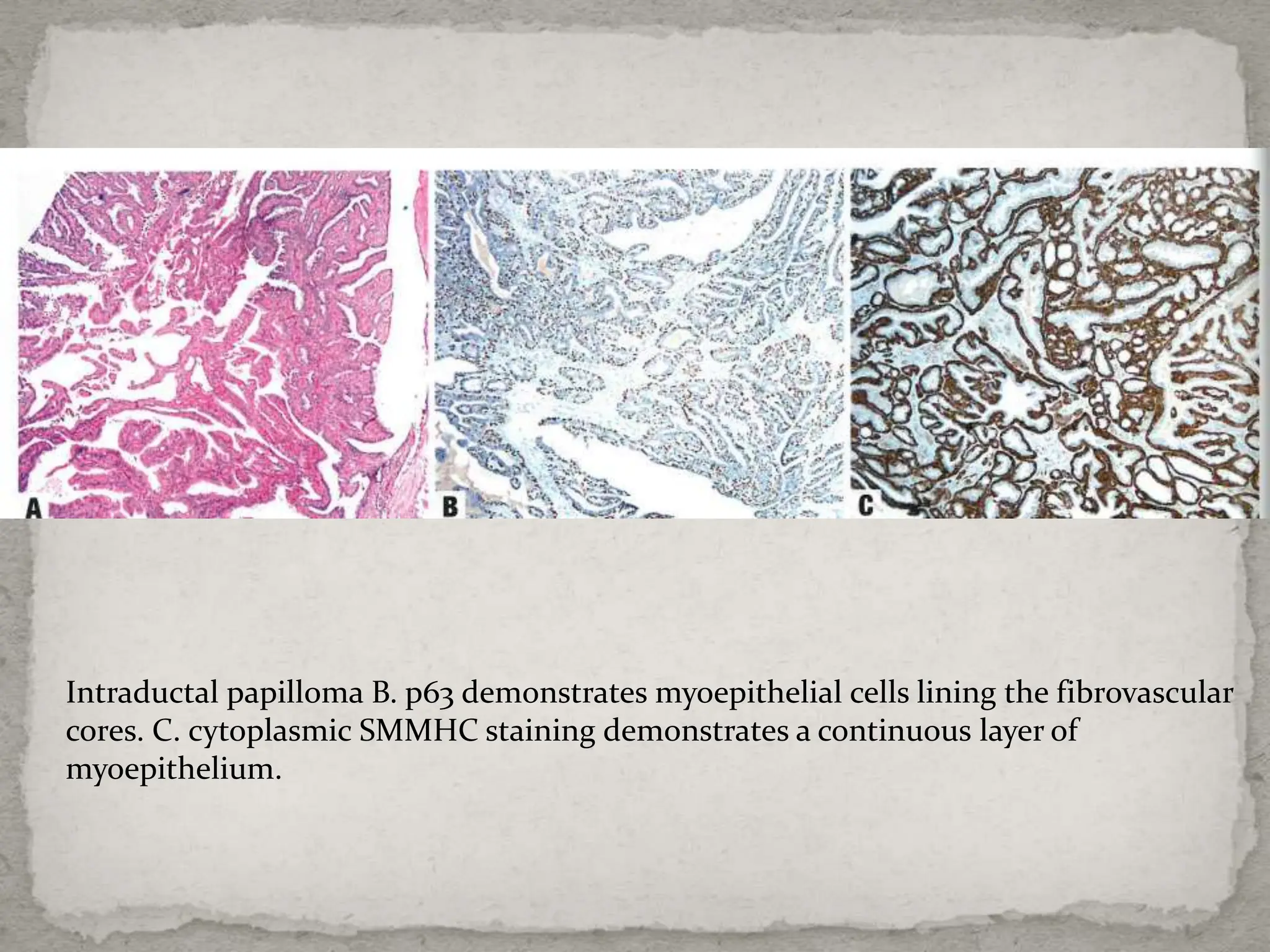An approach to proliferative disease of breast .pptx
