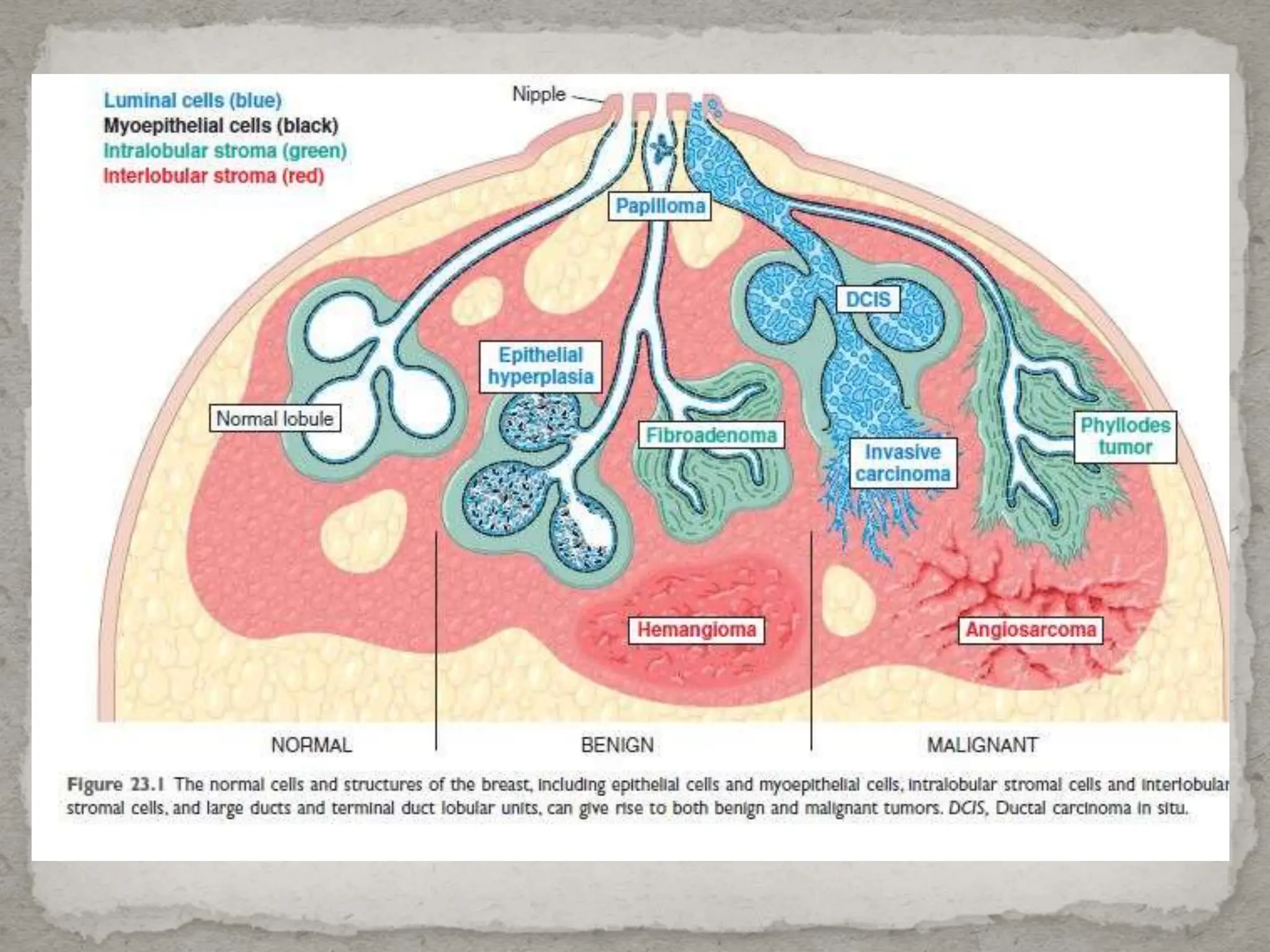 An approach to proliferative disease of breast .pptx