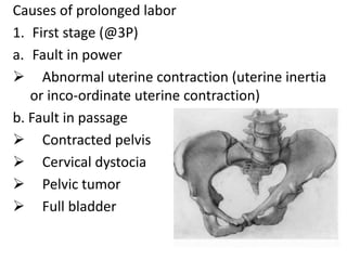 Prolonged and obstructed labor | PPTX