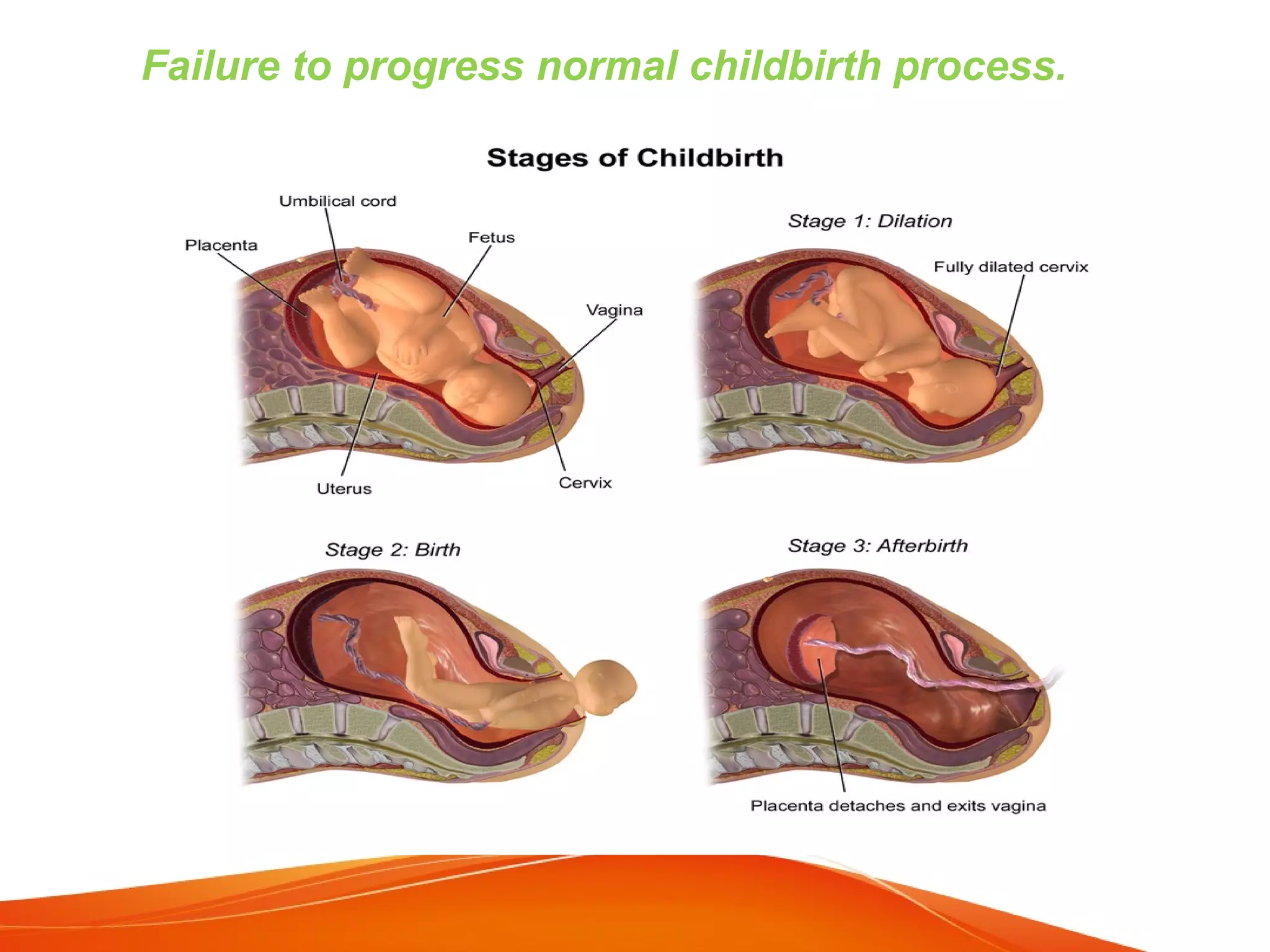 Prolonged labour | PPT