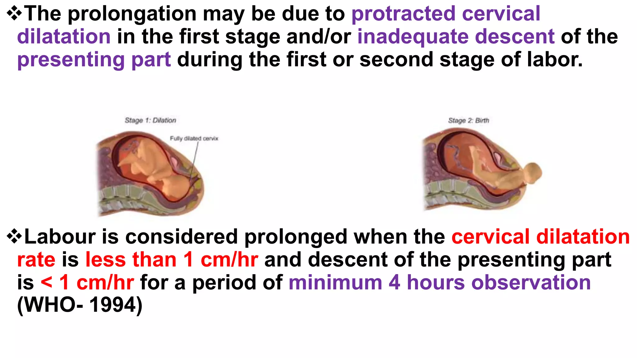 Prolonged labour | PPTX
