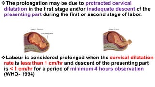 Prolonged labour | PPTX