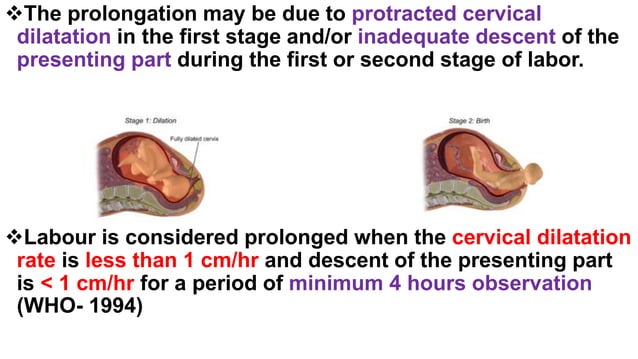 Prolonged labour | PPTX | Pregnancy | Reproductive Health