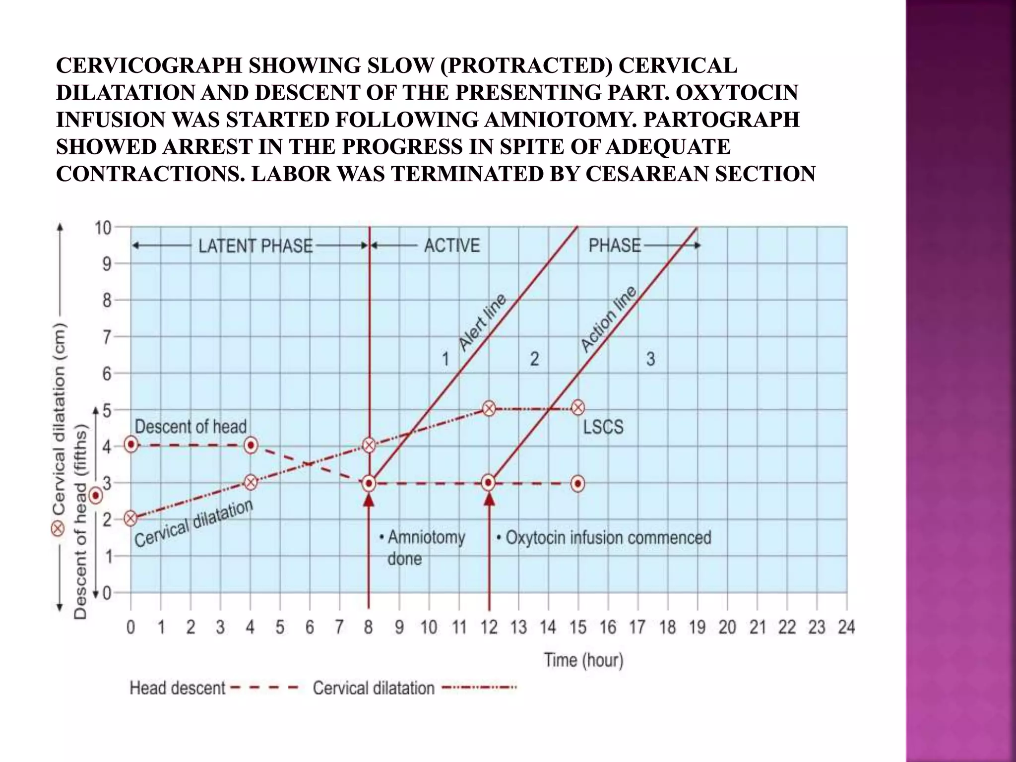 Prolonged labour | PPTX