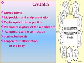 Prolonged labour -gihs | PPT