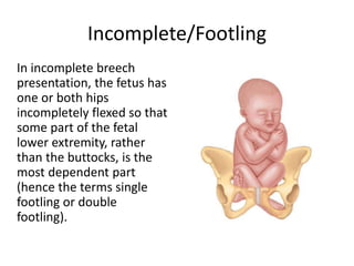 Prolonged labour – cpd, fetal malposition and | PPTX | Pregnancy ...