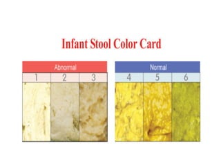 prolonged neonatal jaundiceee ( pNJ ).pdf