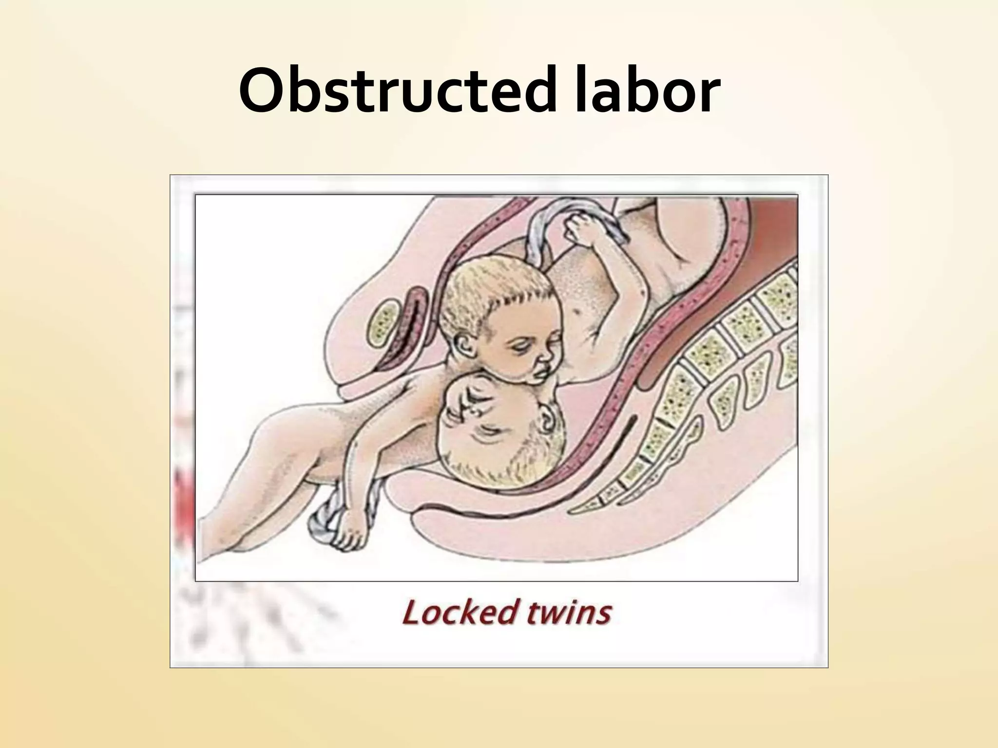 Prolonged and obstructed labour | PPTX