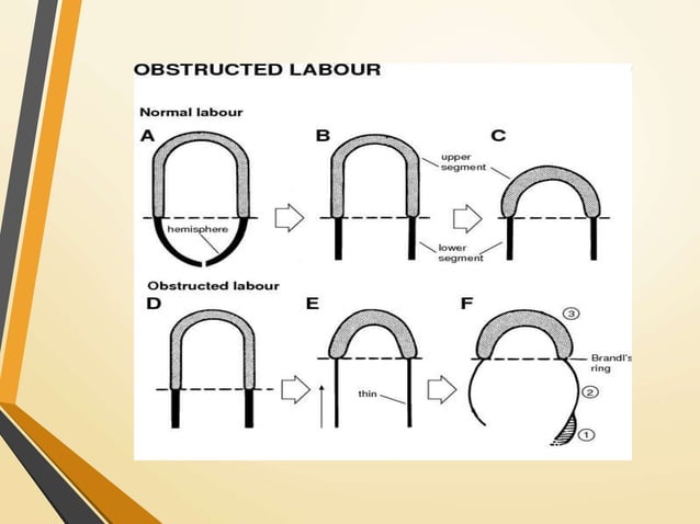 Prolonged and obstructed labour | PPTX | Pregnancy | Reproductive Health