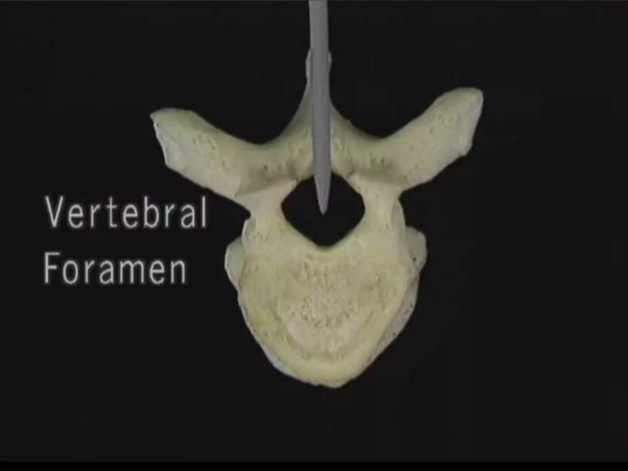 Prolpased inter vertebral disc (pivd) | PPTX