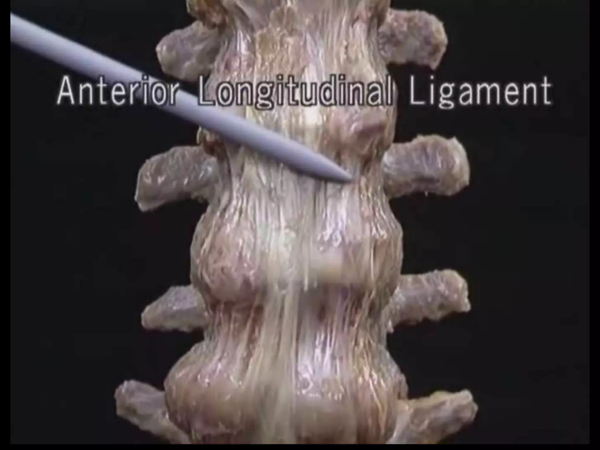 Prolpased inter vertebral disc (pivd) | PPTX