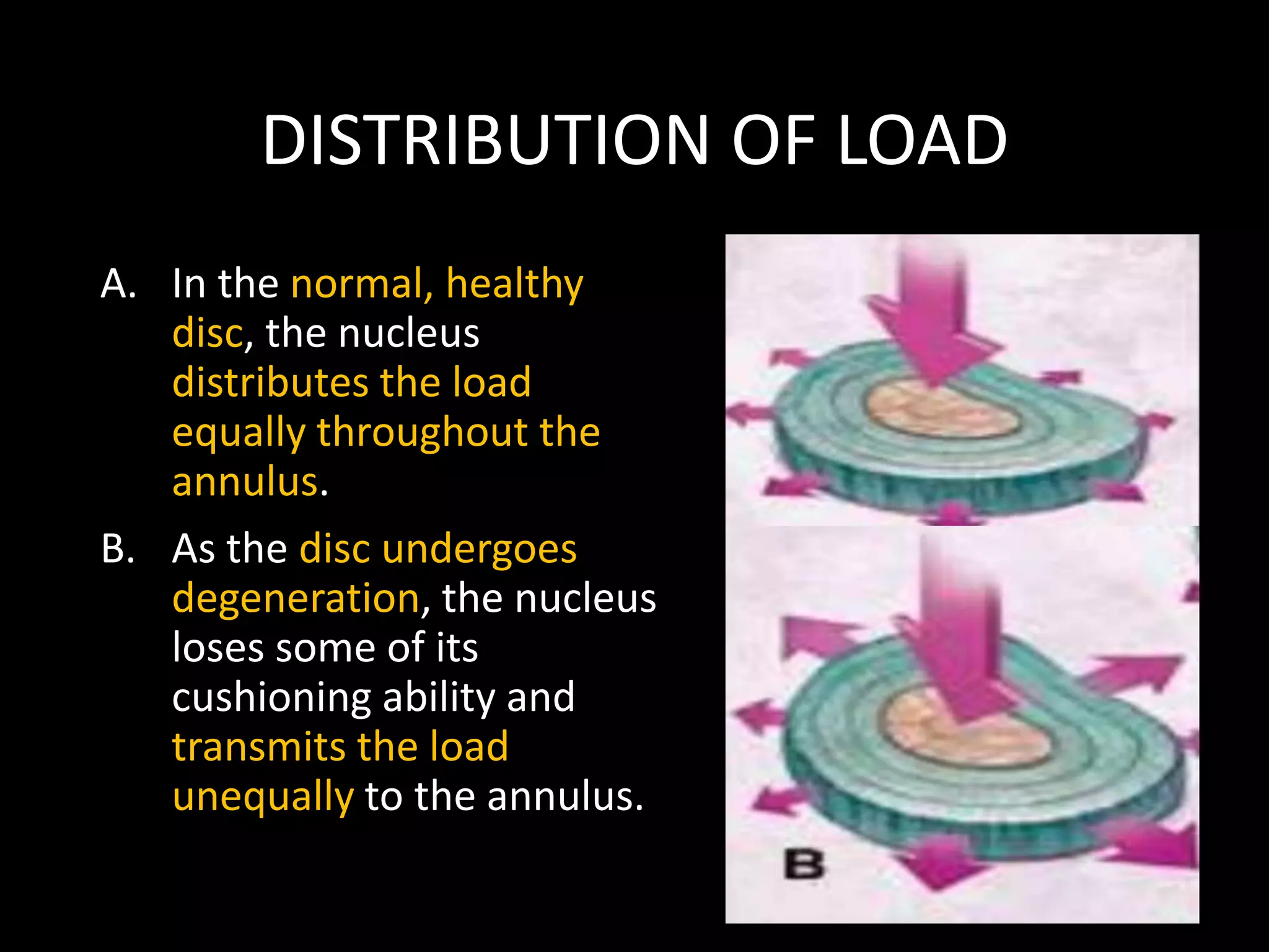 Prolpased inter vertebral disc (pivd) | PPTX