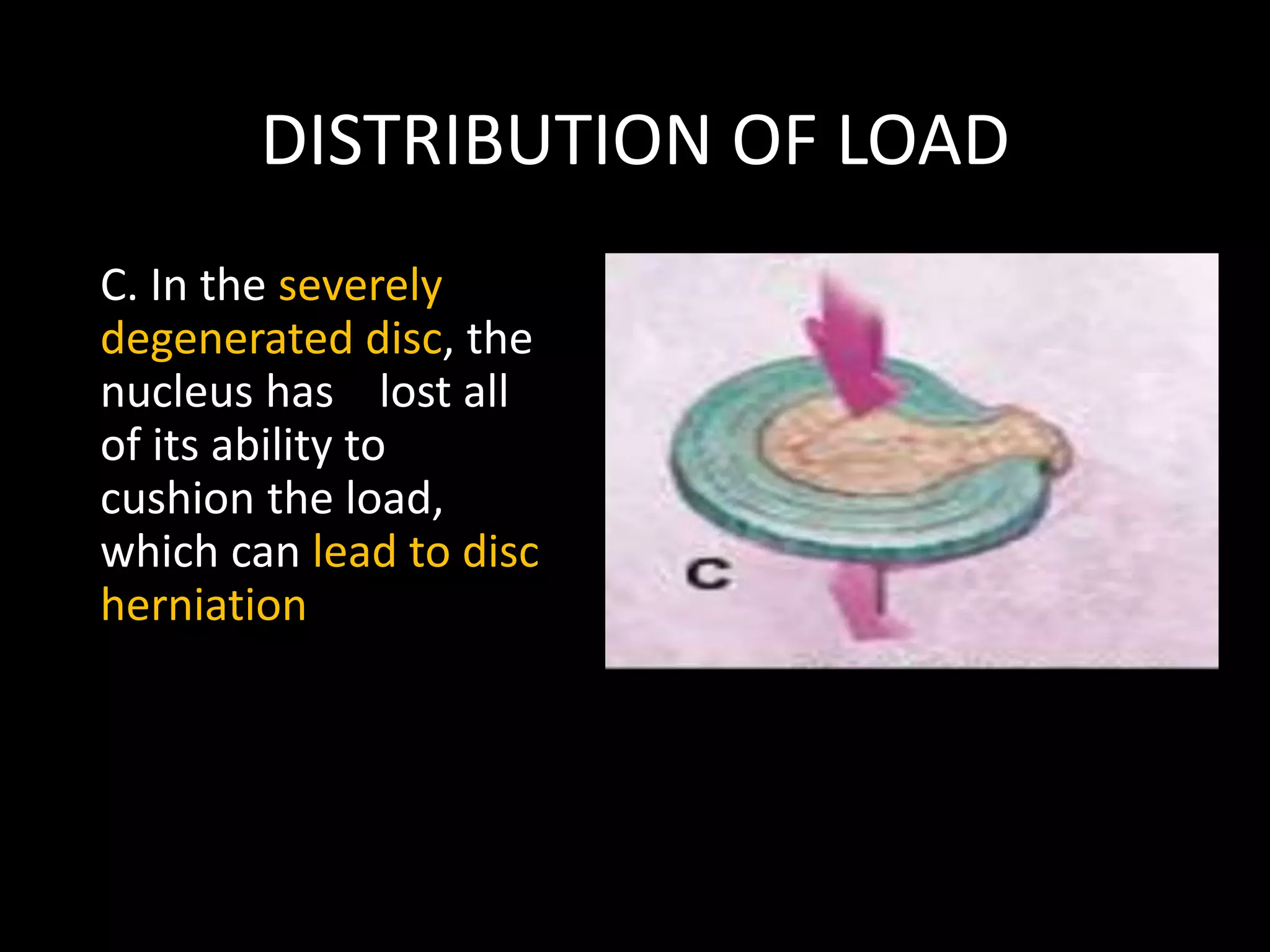 Prolpased inter vertebral disc (pivd) | PPTX | Death, Injury, or ...