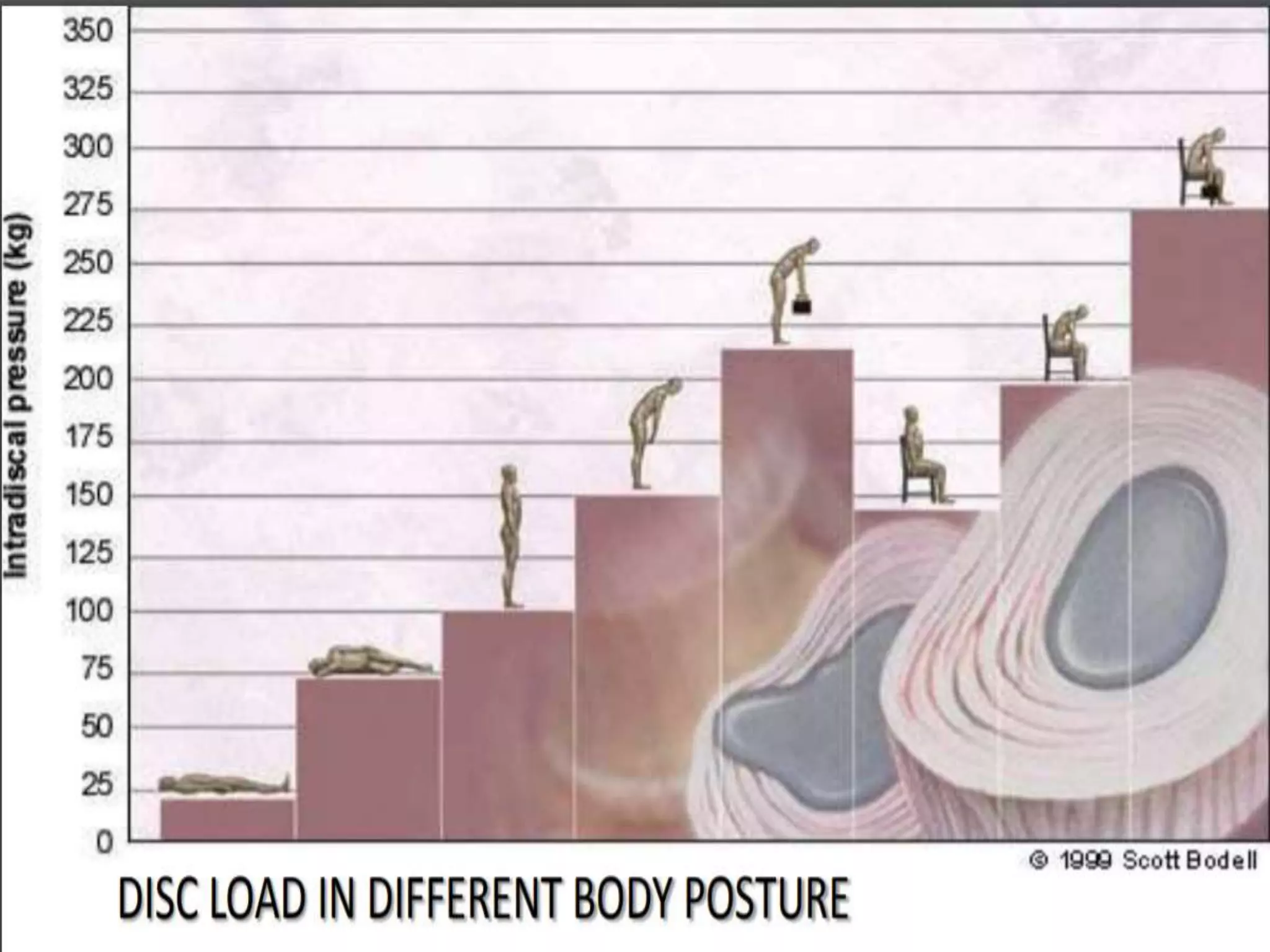 Prolpased inter vertebral disc (pivd) | PPTX