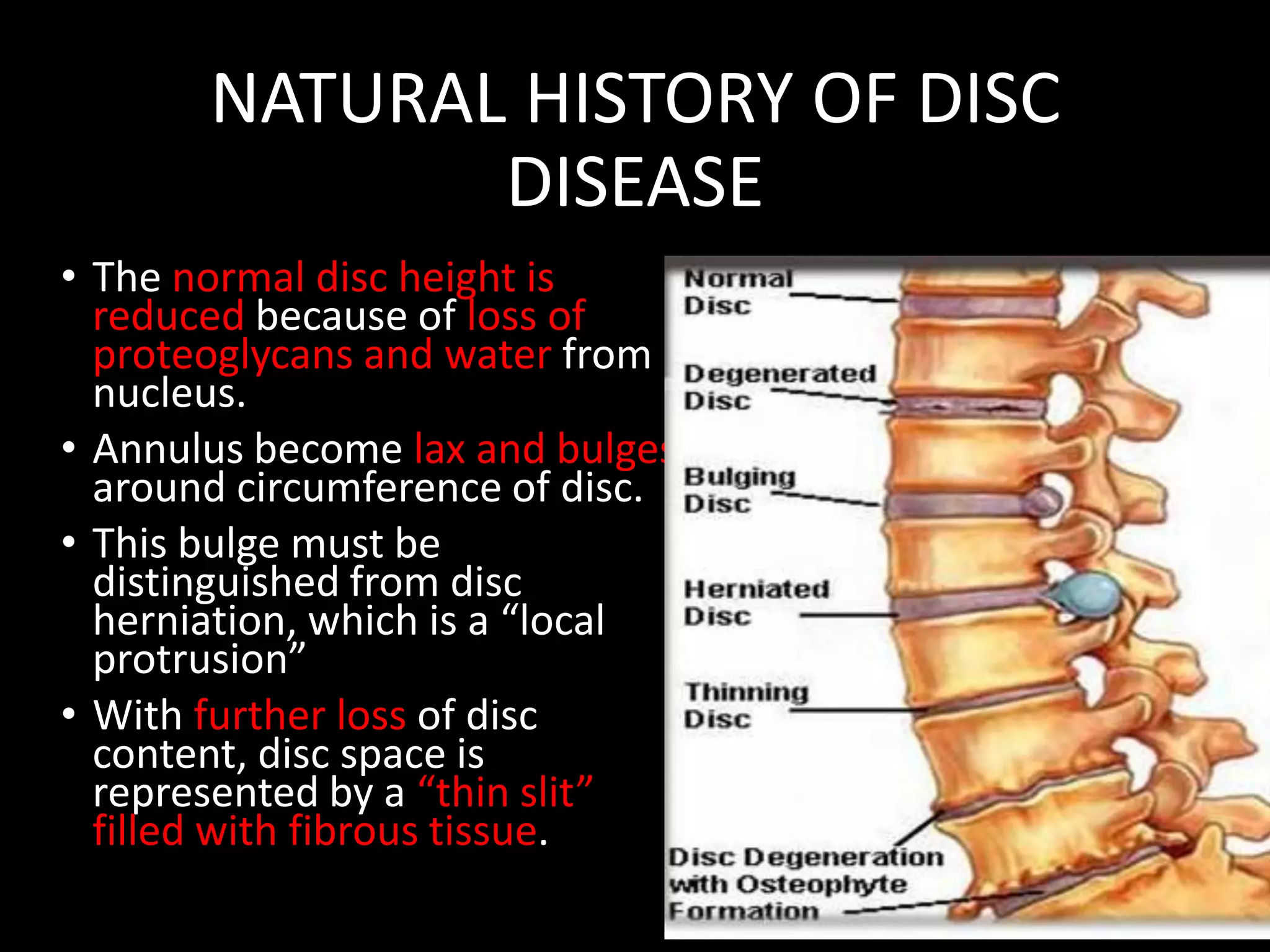 Prolpased inter vertebral disc (pivd) | PPTX