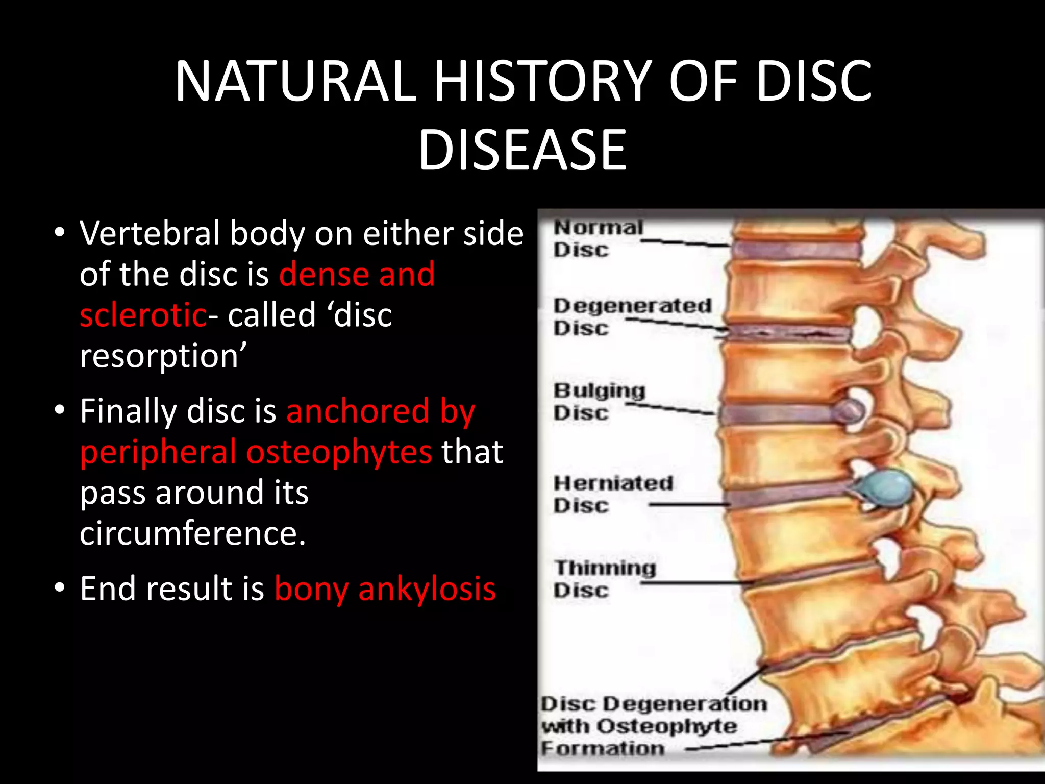 Prolpased inter vertebral disc (pivd) | PPTX