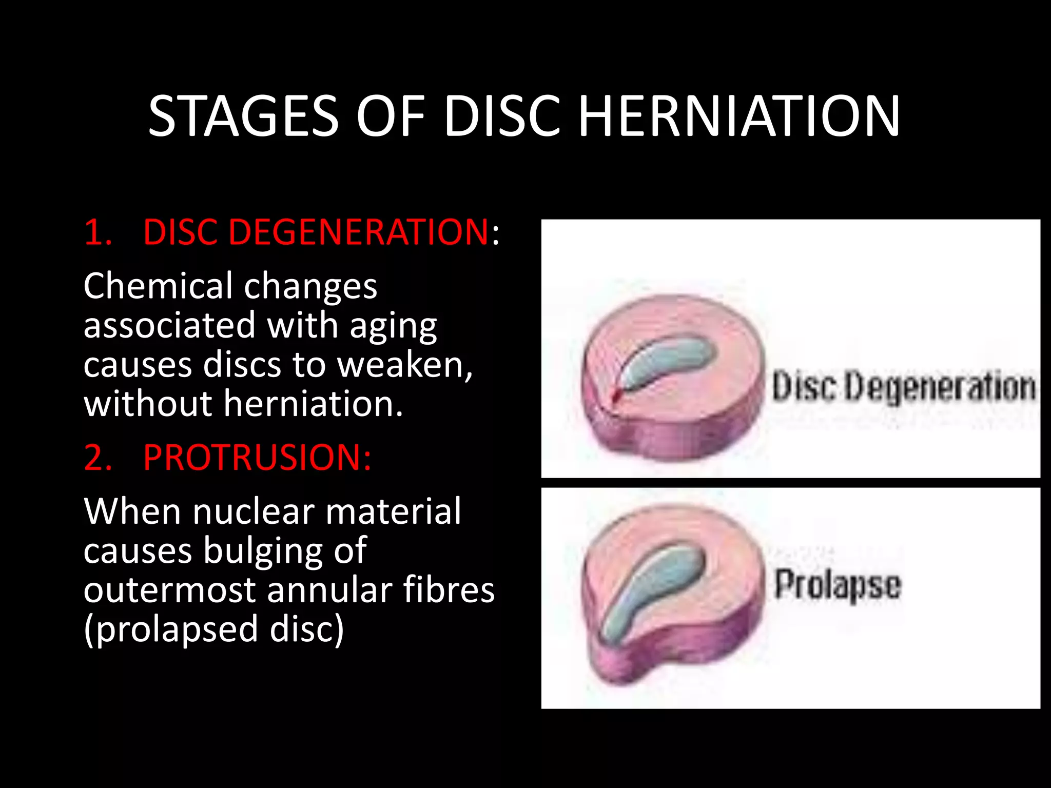 Prolpased inter vertebral disc (pivd) | PPTX