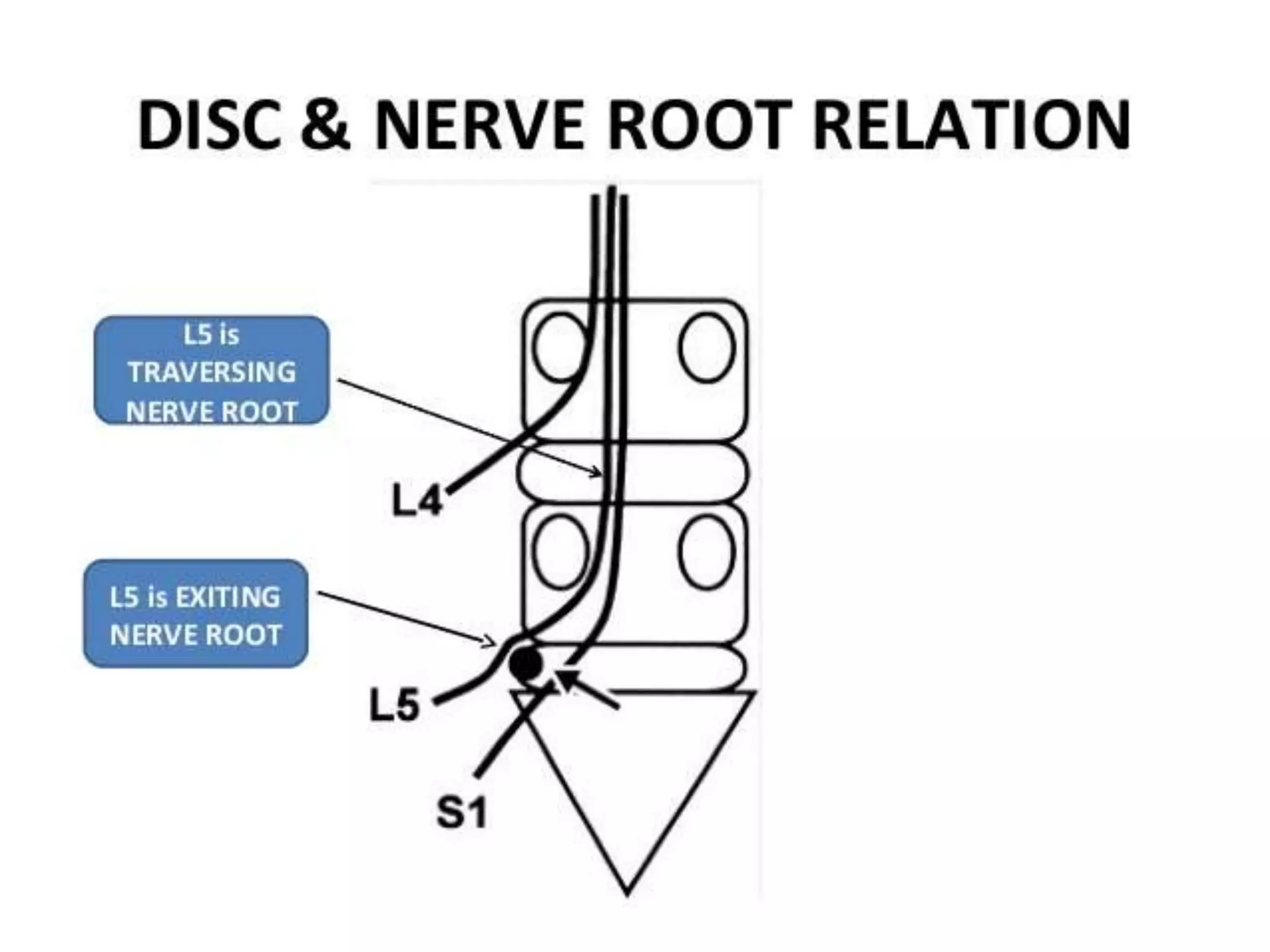 Prolpased inter vertebral disc (pivd) | PPTX | Death, Injury, or ...