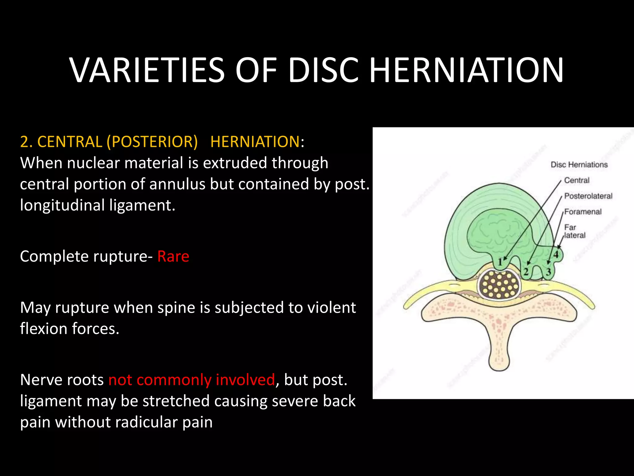 Prolpased inter vertebral disc (pivd) | PPTX
