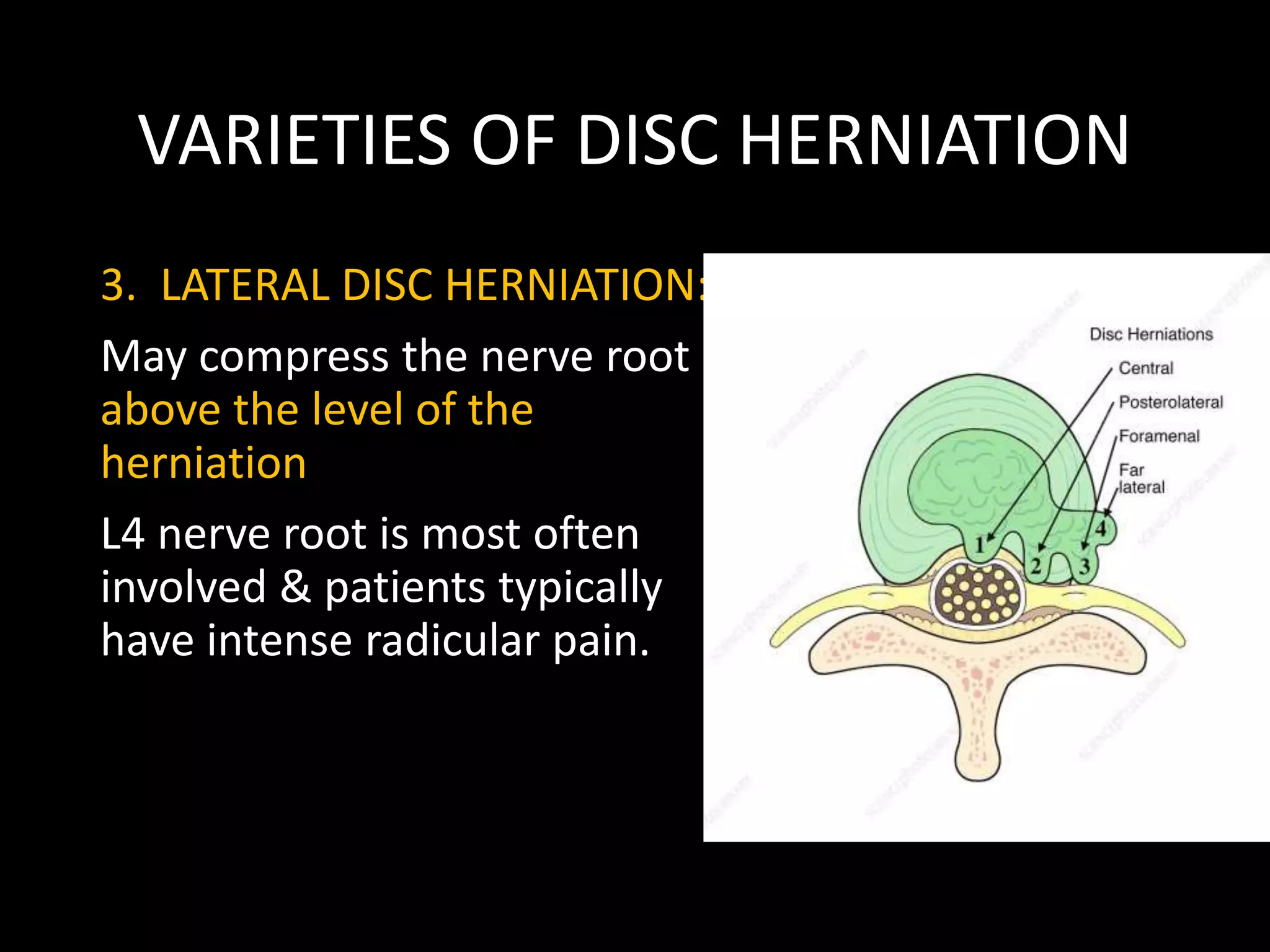 Prolpased inter vertebral disc (pivd) | PPTX