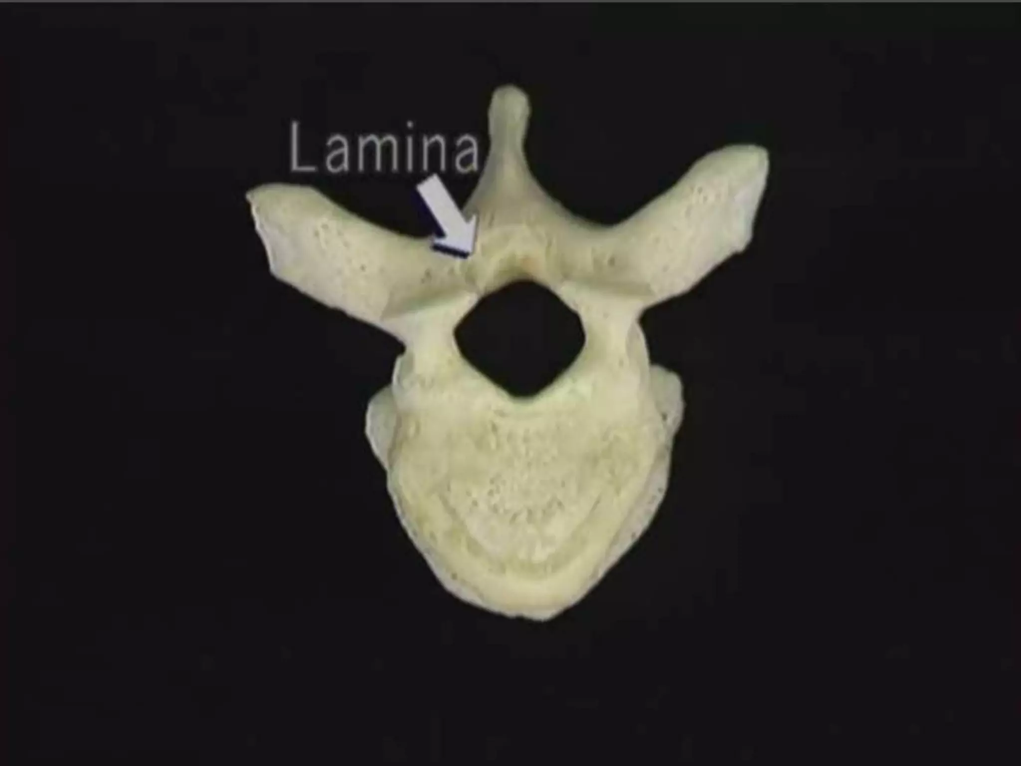 Prolpased inter vertebral disc (pivd) | PPTX