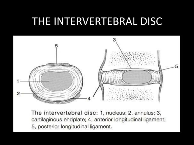 Prolpased inter vertebral disc (pivd) | PPTX | Death, Injury, or ...