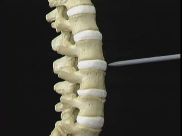 Prolpased inter vertebral disc (pivd) | PPTX | Death, Injury, or ...