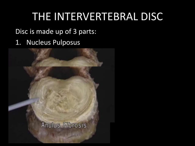 Prolpased inter vertebral disc (pivd) | PPTX | Death, Injury, or ...