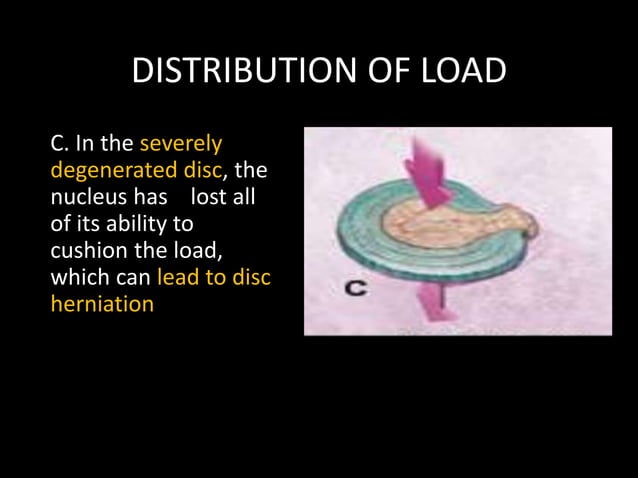 Prolpased inter vertebral disc (pivd) | PPTX | Death, Injury, or ...