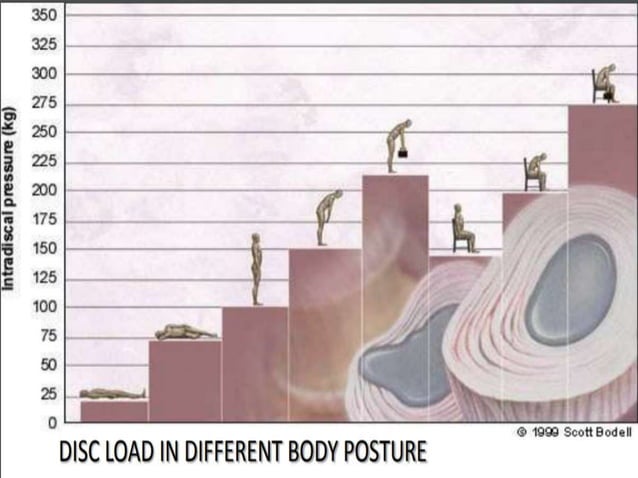 Prolpased inter vertebral disc (pivd) | PPTX | Death, Injury, or ...