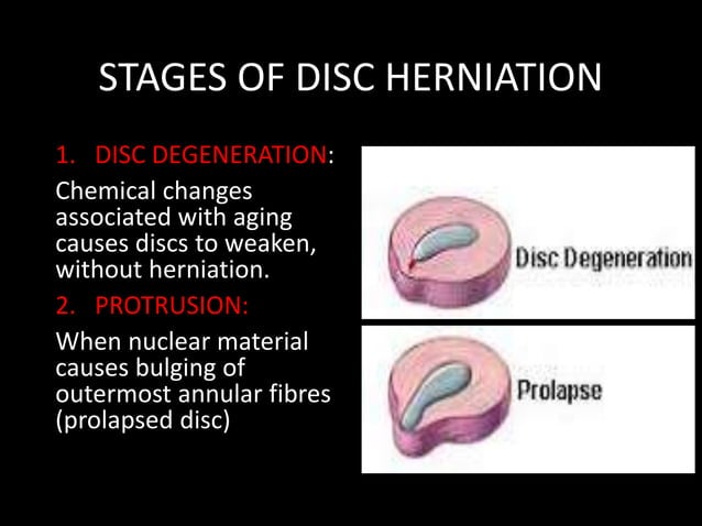 Prolpased inter vertebral disc (pivd) | PPTX | Death, Injury, or ...